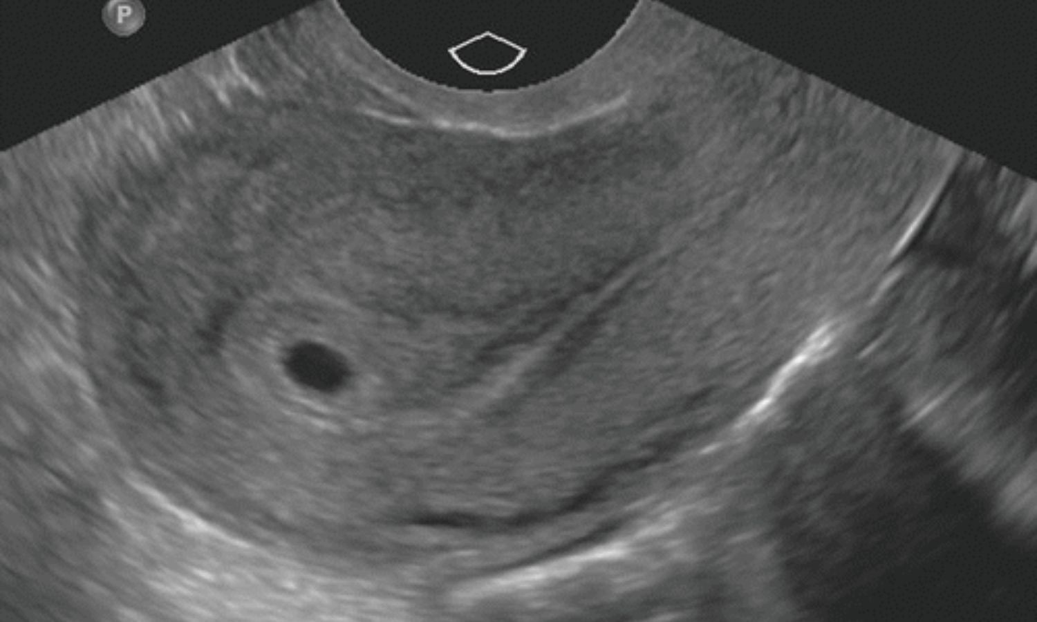 Society of Radiologists in Ultrasound Updates First-Trimester ...