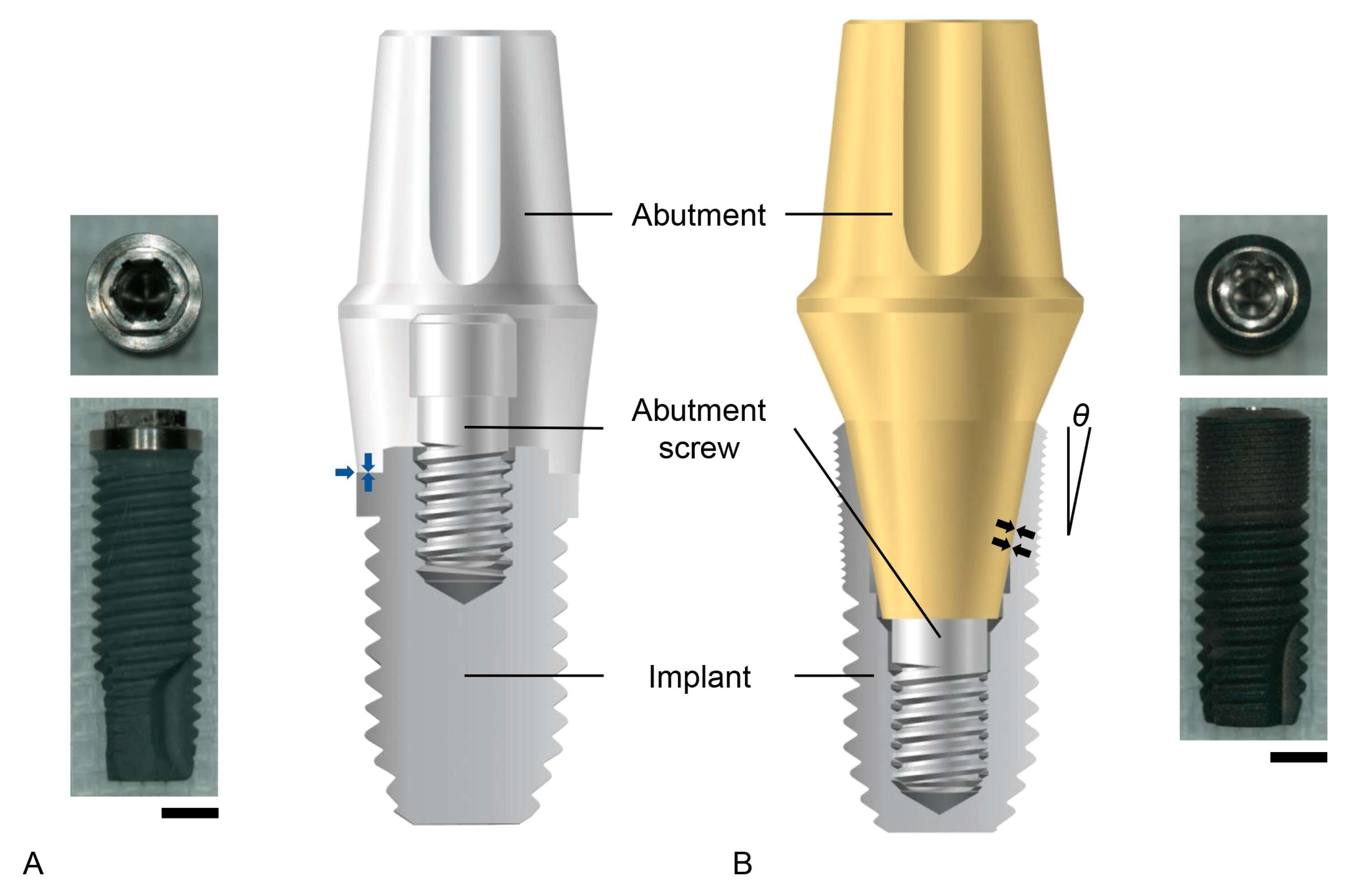 Titanium base abutments suitable abutment choice for medium-term ...