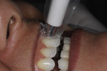 Trueness of shade matching with intraoral scanners low compared to ...