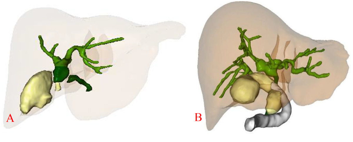 Application of 3D visualization technology facilitates repair of bile ...