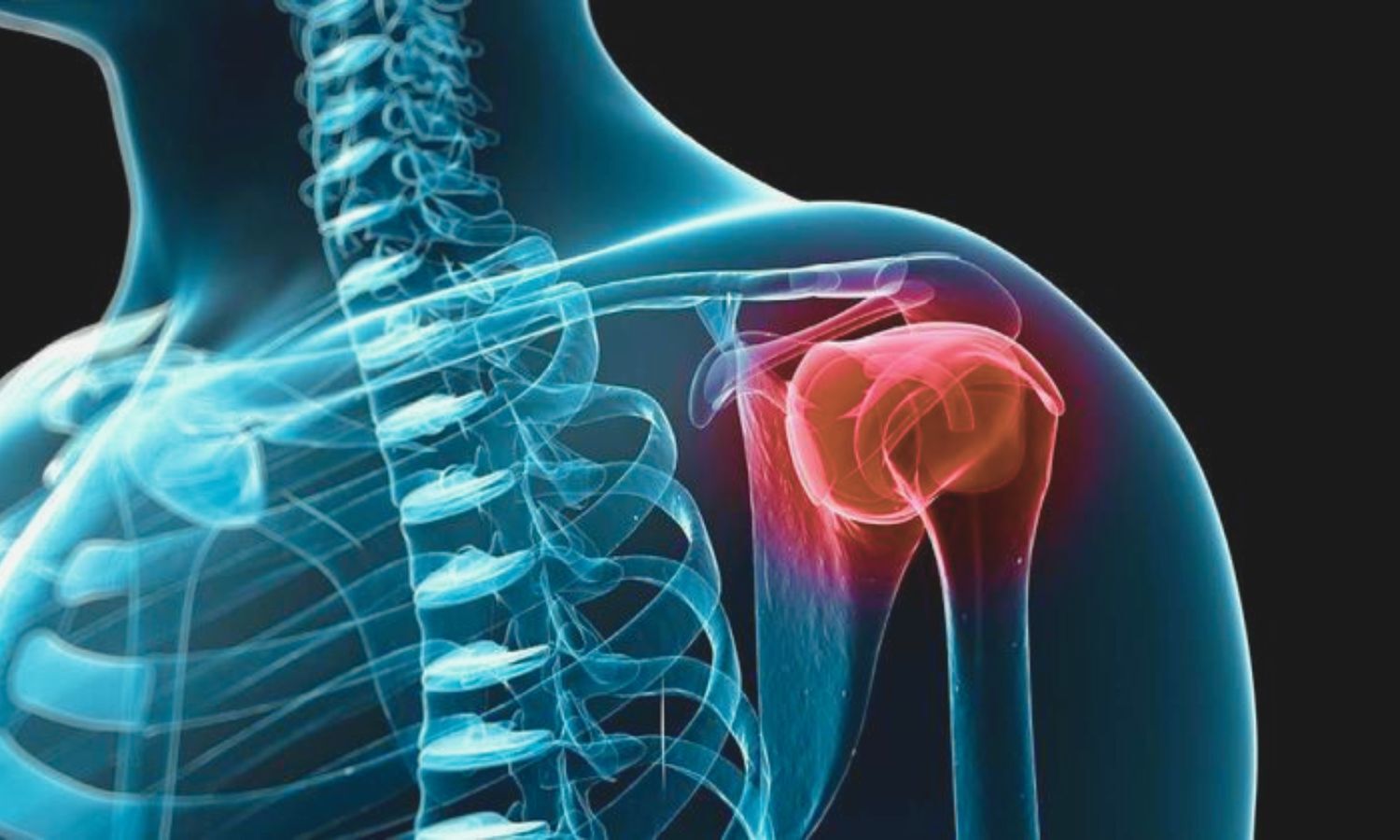 Positive Outcomes for Rotator Cuff Healing with Bioinductive Collagen ...