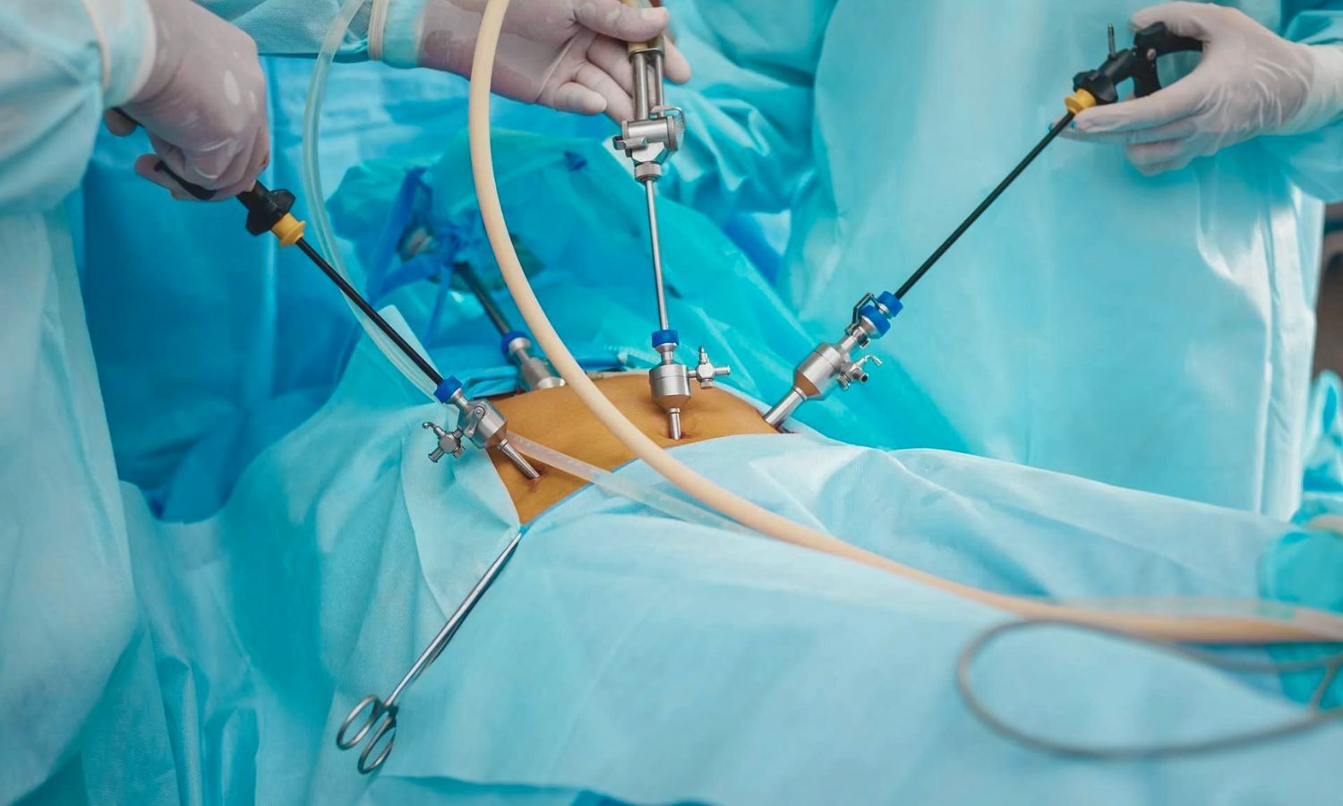 Radical Cystectomy Safe in Well-Selected Octogenarians, finds study