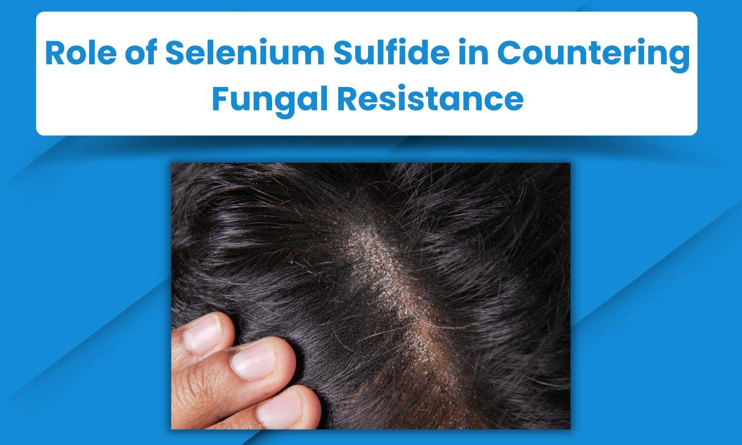Combatting Anti-fungal Resistance: Selenium Sulfide as a Promising ...
