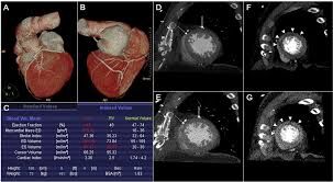 Study supports CT coronary angiography before invasive coronary ...