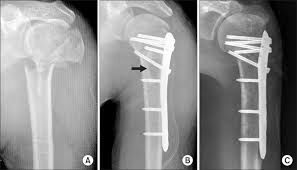 Minimally invasive lateral shoulder approach safe and effective for ...