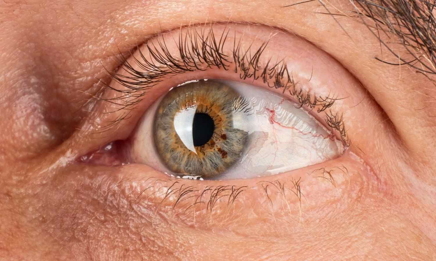 FDA approves ENCELTO, first-of-its-kind eye implant that slows vision ...