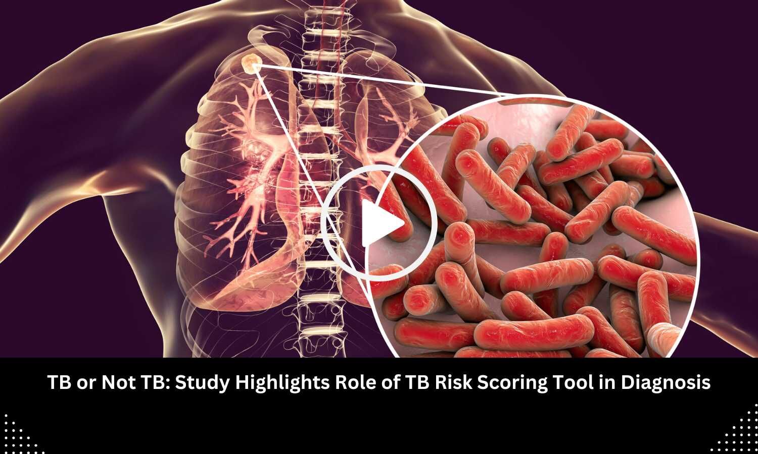 TB or Not TB: Study Highlights Role of TB Risk Scoring Tool in Diagnosis