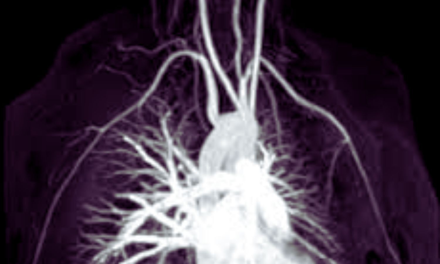 Ferumoxytol-Enhanced MR Angiography: Safe and Effective Imaging Option ...