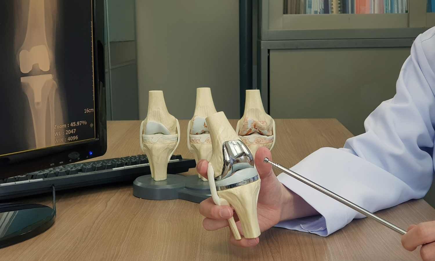NPPA to Examine Separate Price Category for Cementless Knee Implants ...