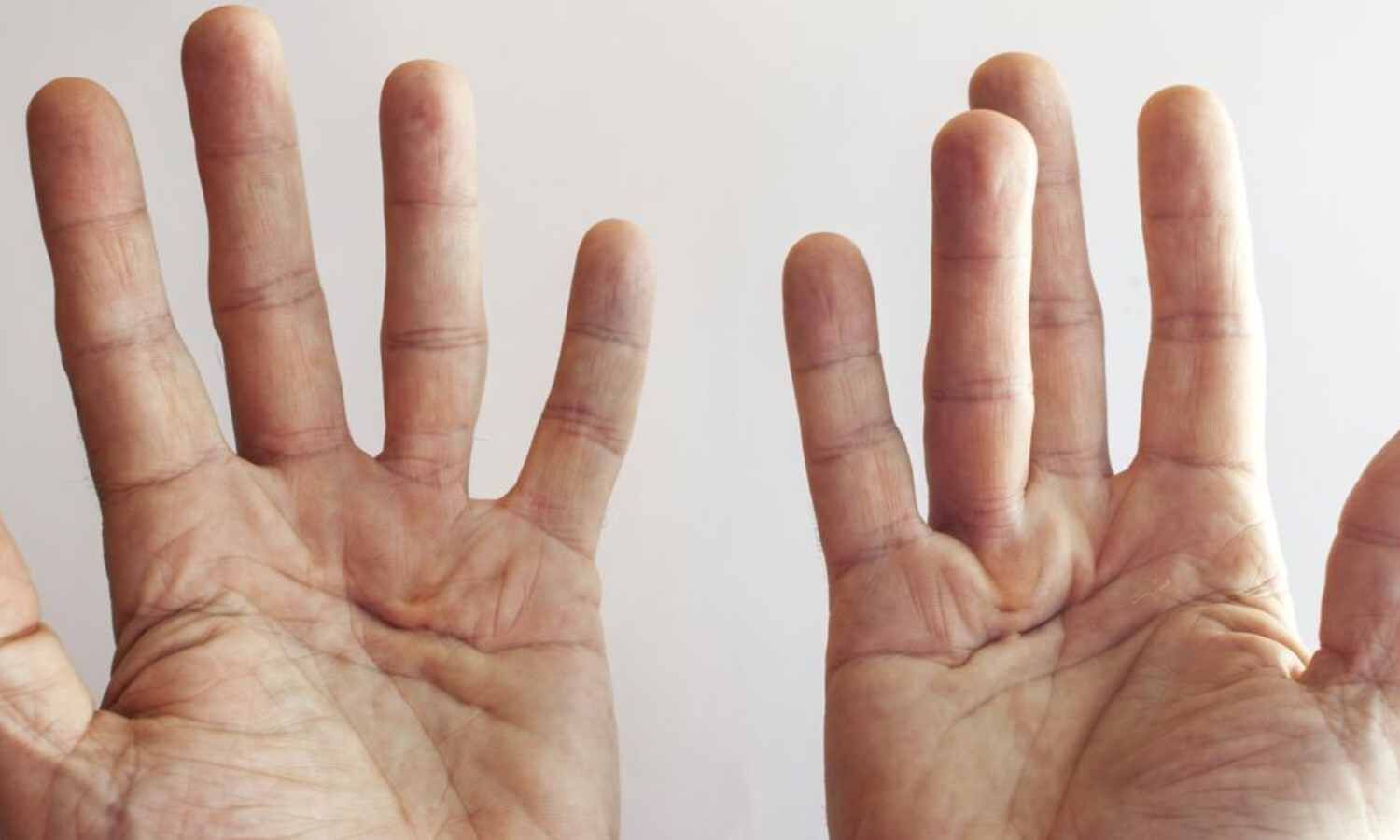 Collagenase Injection More Effective Than Needle Fasciotomy for Primary ...