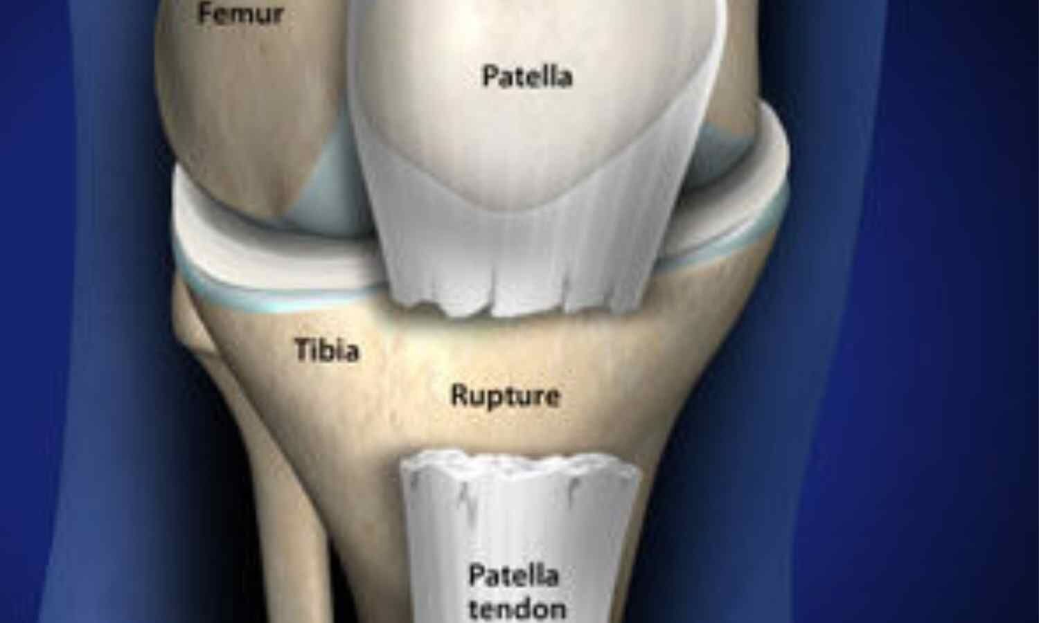 Neglected Patellar Tendon Rupture treated with Semitendinosus Tendon ...