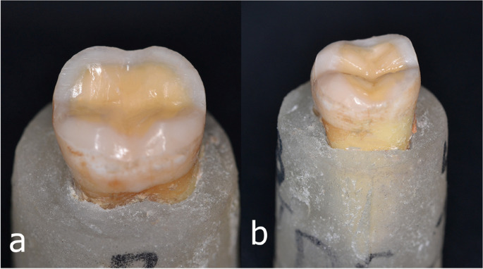 Immediate Dentin Sealing may Improve Adhesion and Restoration ...