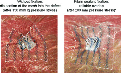 Positive-Pressure Exhaust Technique Improves Mesh Fixation in TAPP ...