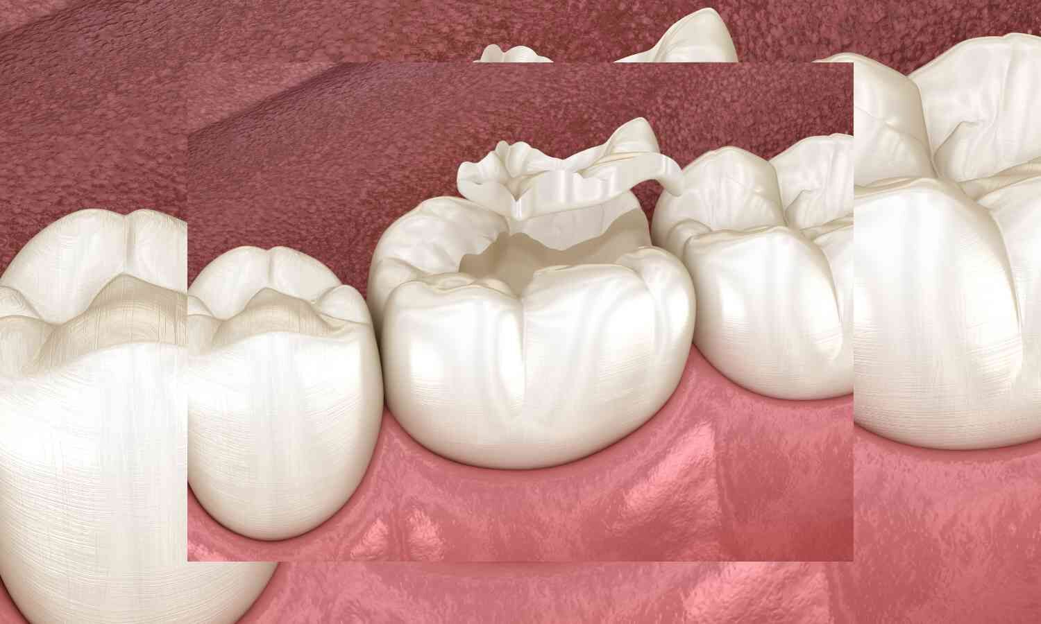 External Splinting Shows Promise for Cracked Teeth with Reversible ...