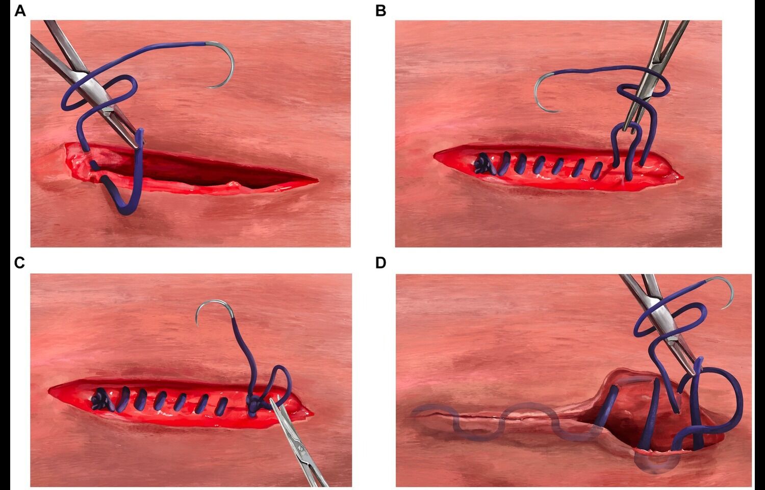 Barbed Sutures Improve Laparoscopic Tubal Anastomosis Outcomes ...