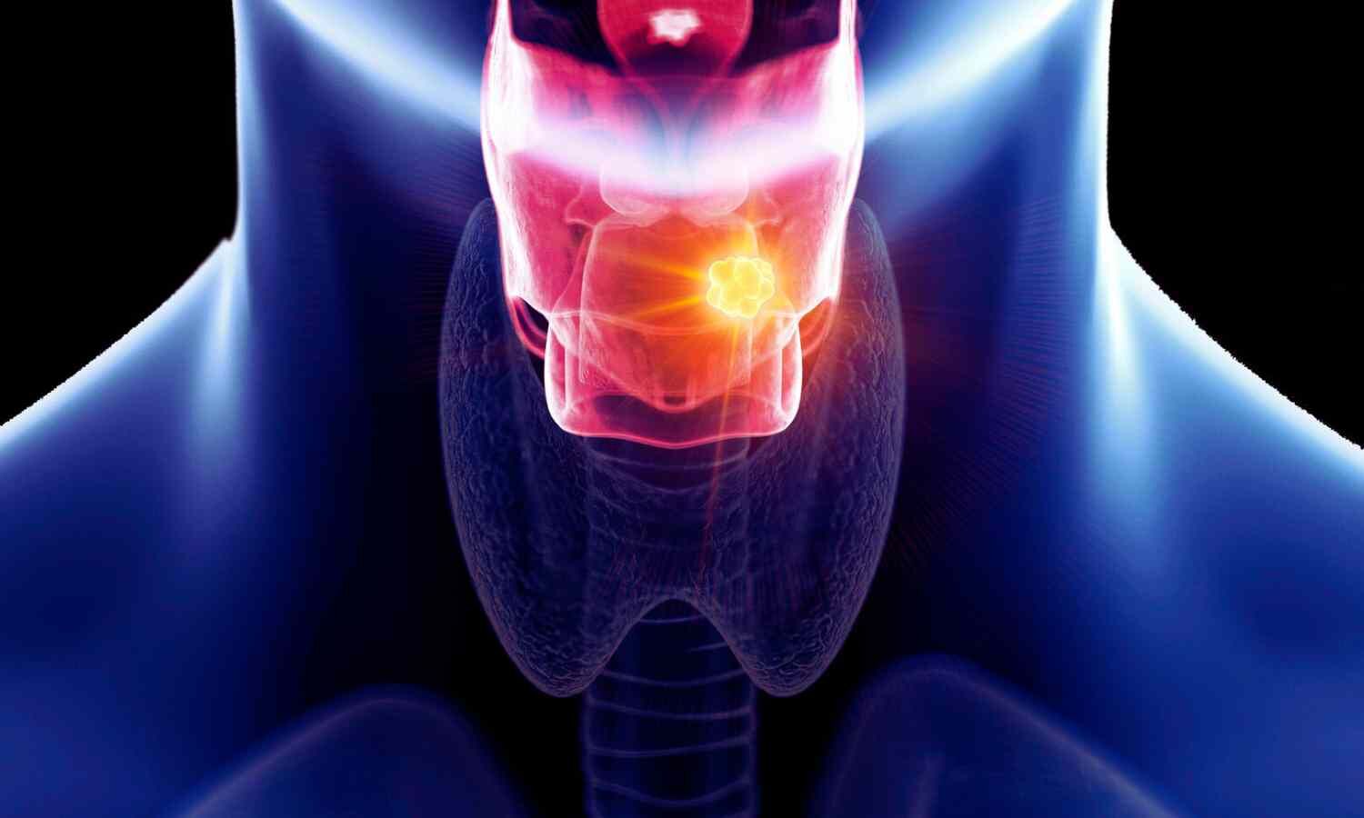 AI could soon detect early voice box cancer from the sound of your ...