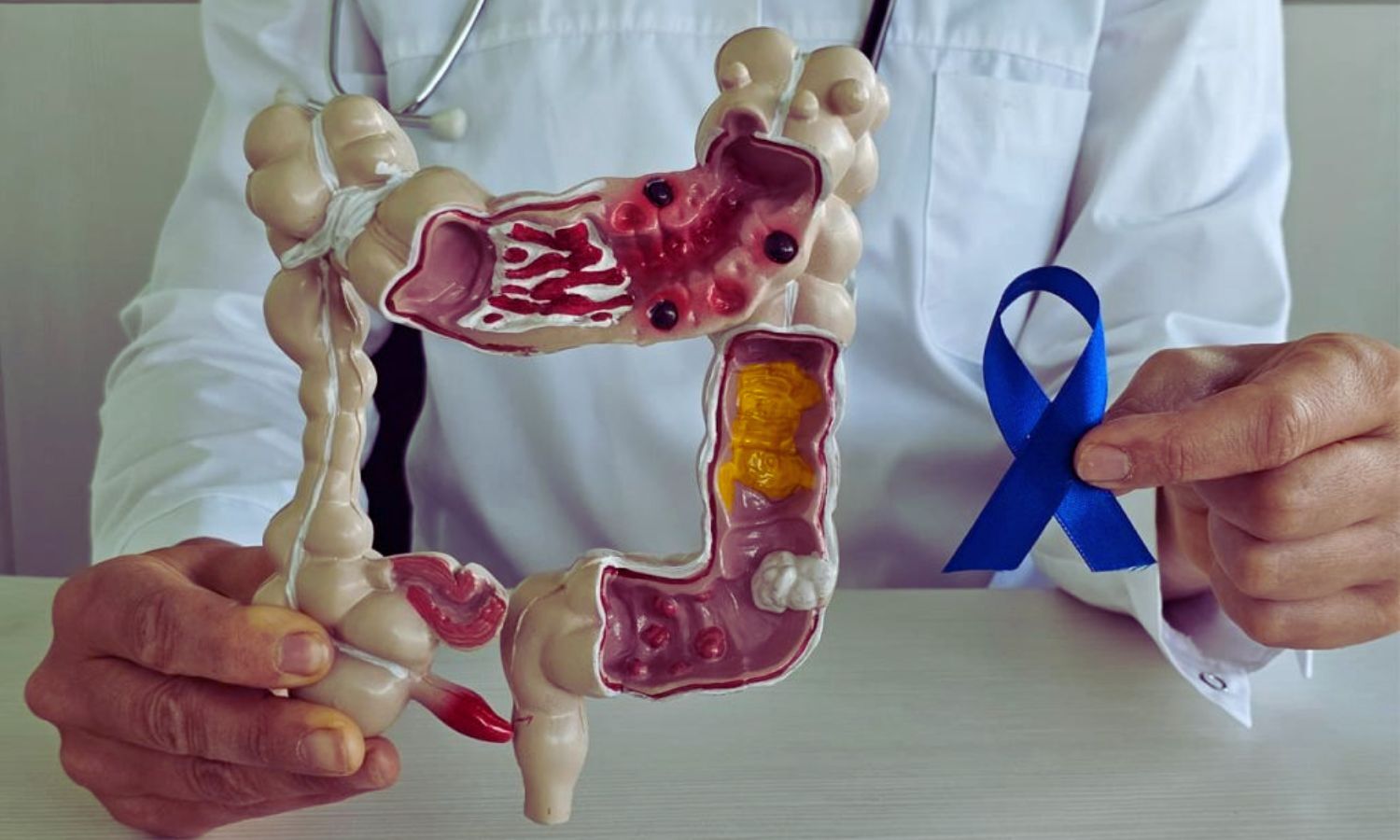 Hand-sewn Anastomosis: Primary Predictor of Postoperative Ileus ...