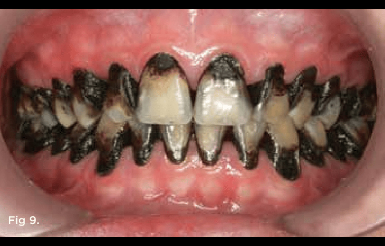SDF Treatment Superior in Arresting Early Approximal Caries: Study