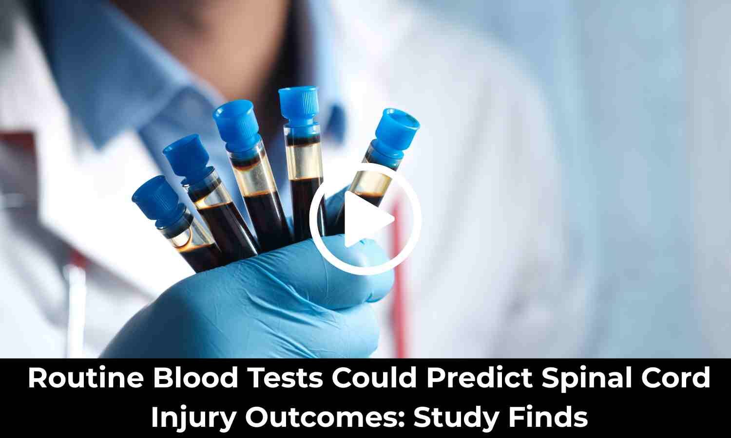 Routine Blood Tests Could Predict Spinal Cord Injury Outcomes: Study Finds