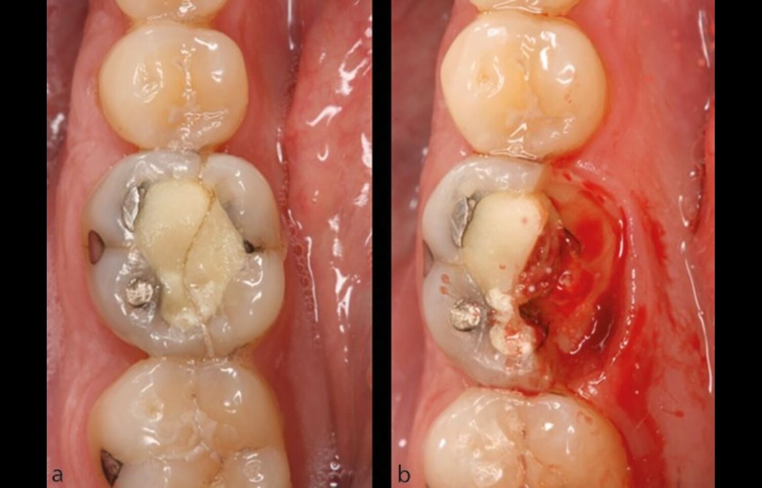 Timing of Restoration After RCT Does Not Impact 5-Year Outcomes ...