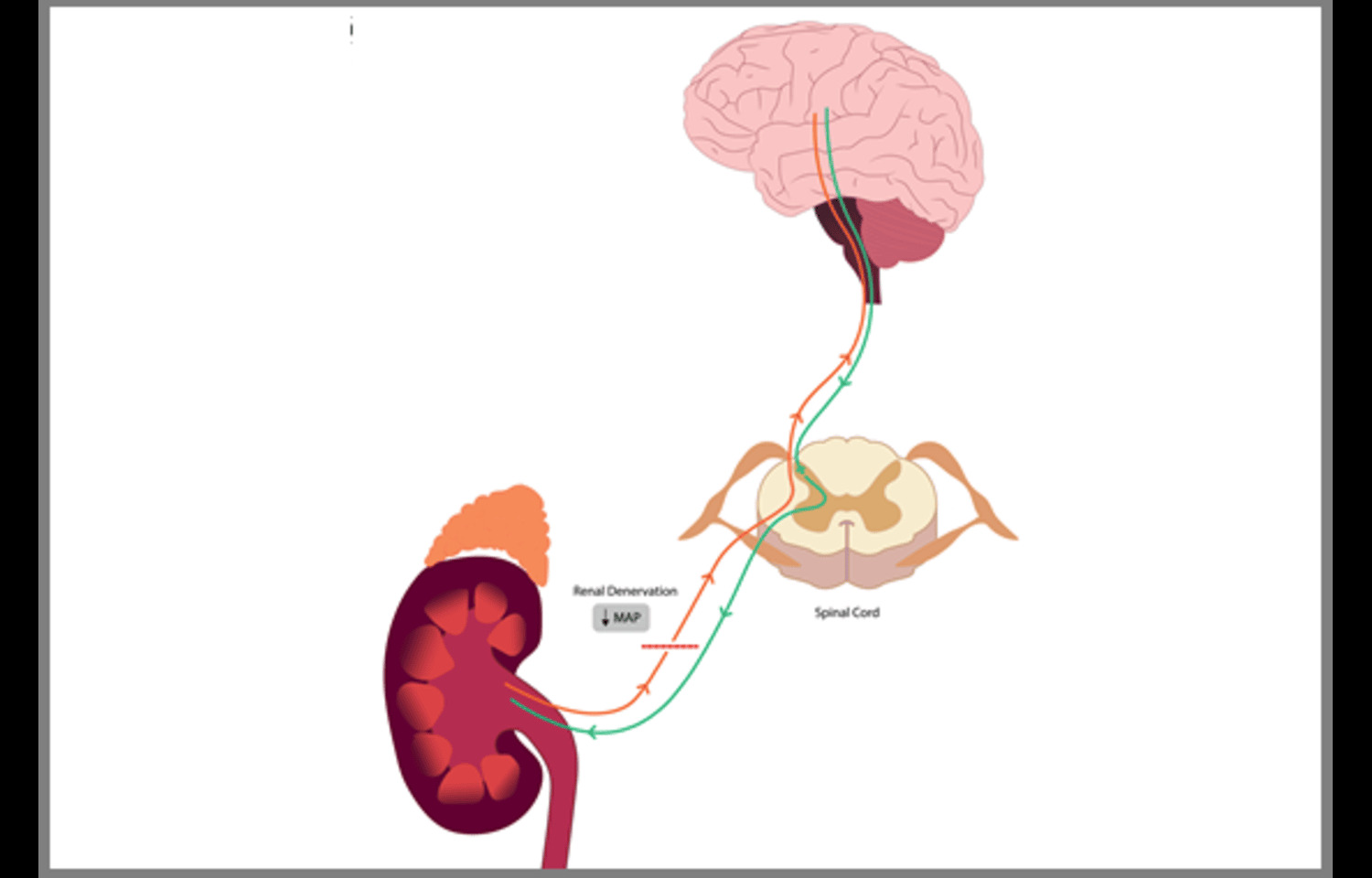 Radiofrequency Renal Denervation effective on long term basis among ...