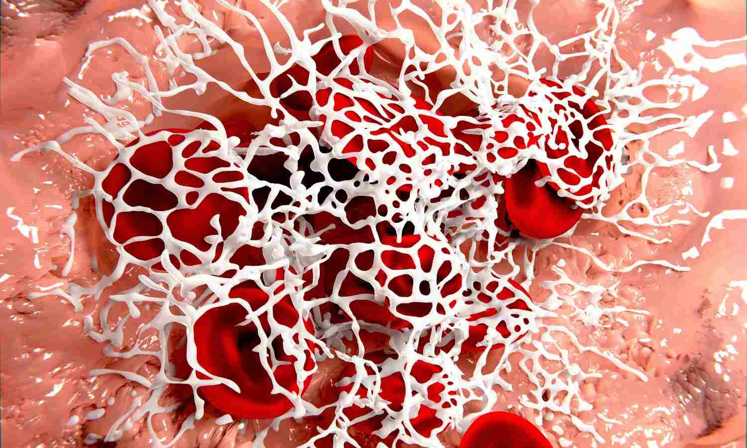 Effectiveness of anti-clotting meds after stent placement varied in ...
