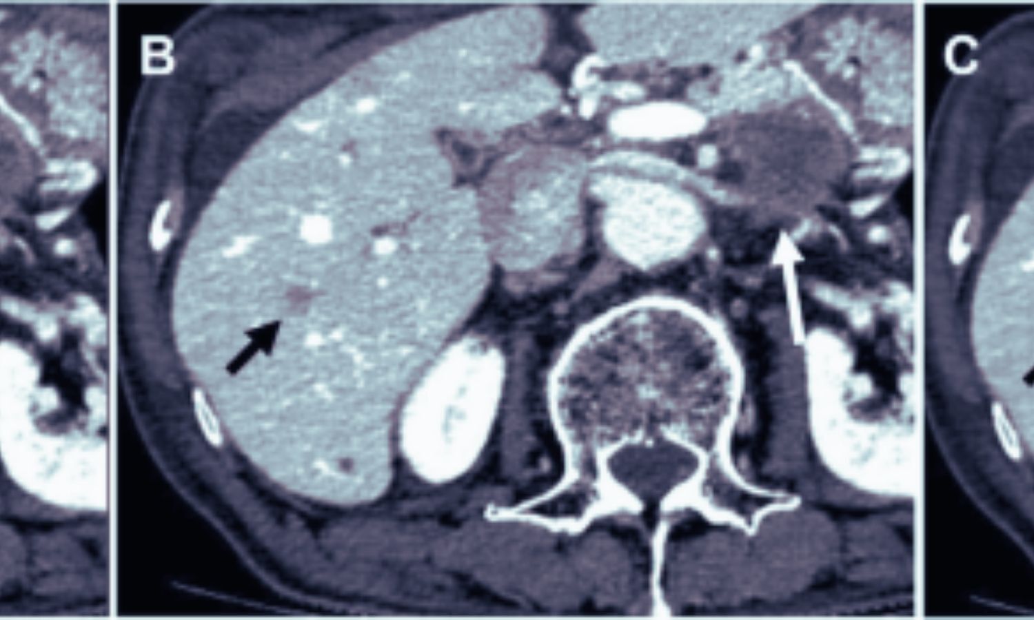Deep Learning Boosts Image Quality in Low-Dose CT Portal Venography ...