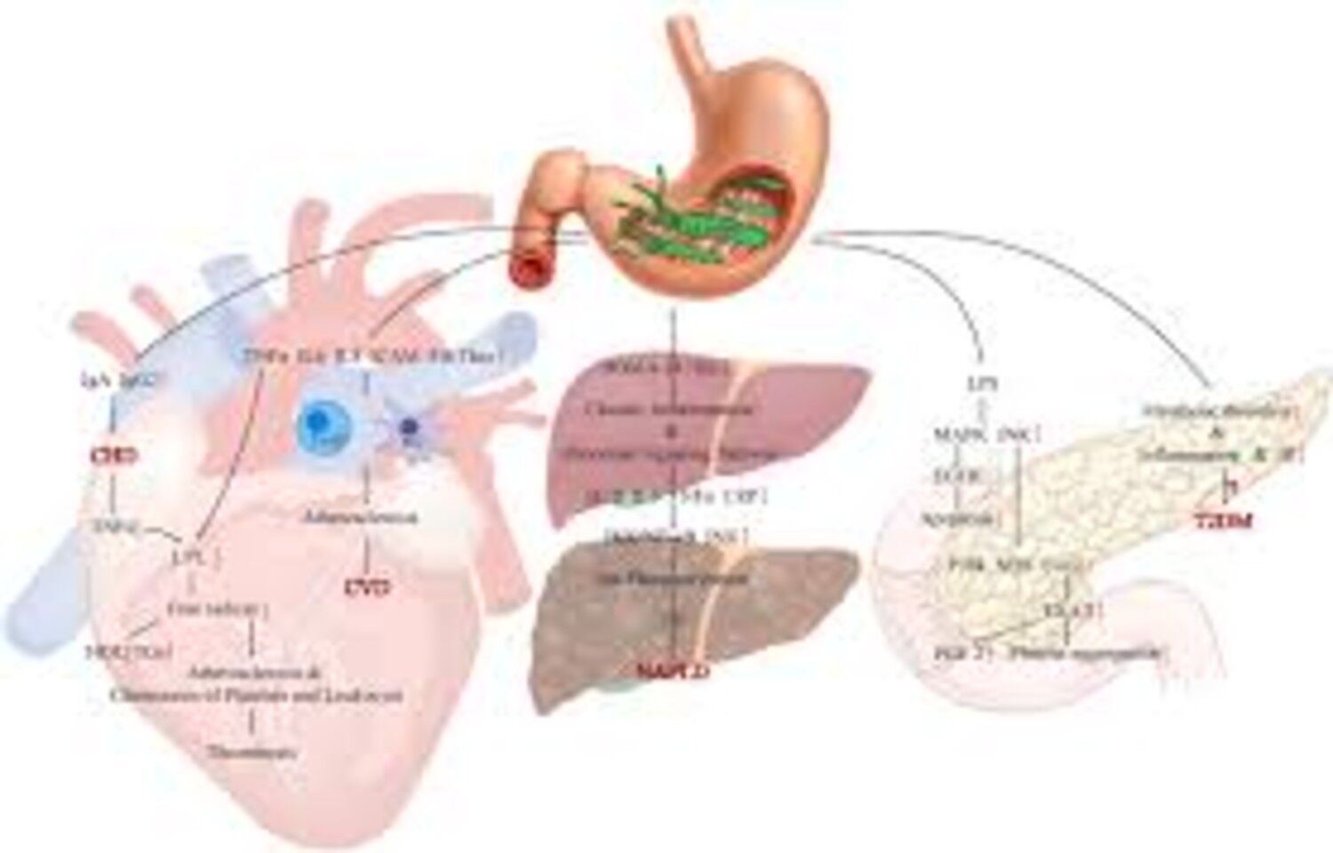 H. pylori Infection Linked to Elevated remnant cholesterol Levels via ...