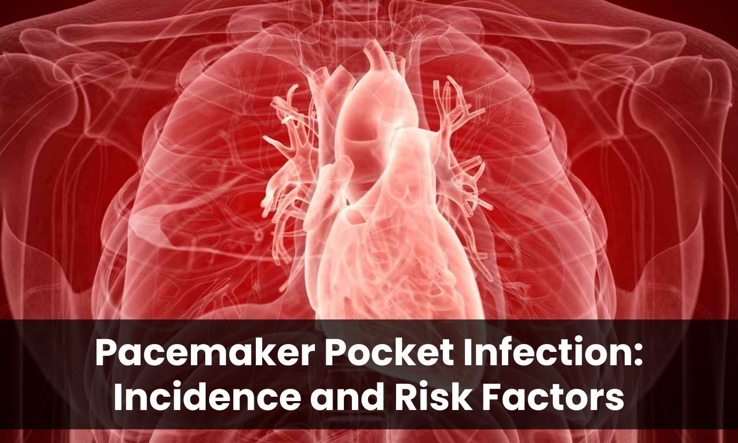 Pacemaker Pocket Infection: IHJ, 2025 Indian Study Reveals Incidence ...
