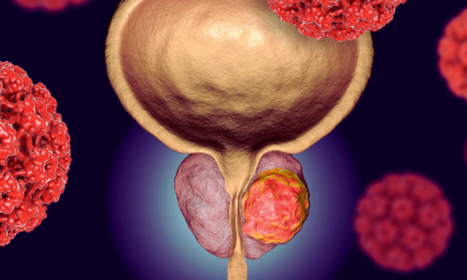 Bellmunt Risk Score Predicts Survival in Metastatic Castration ...