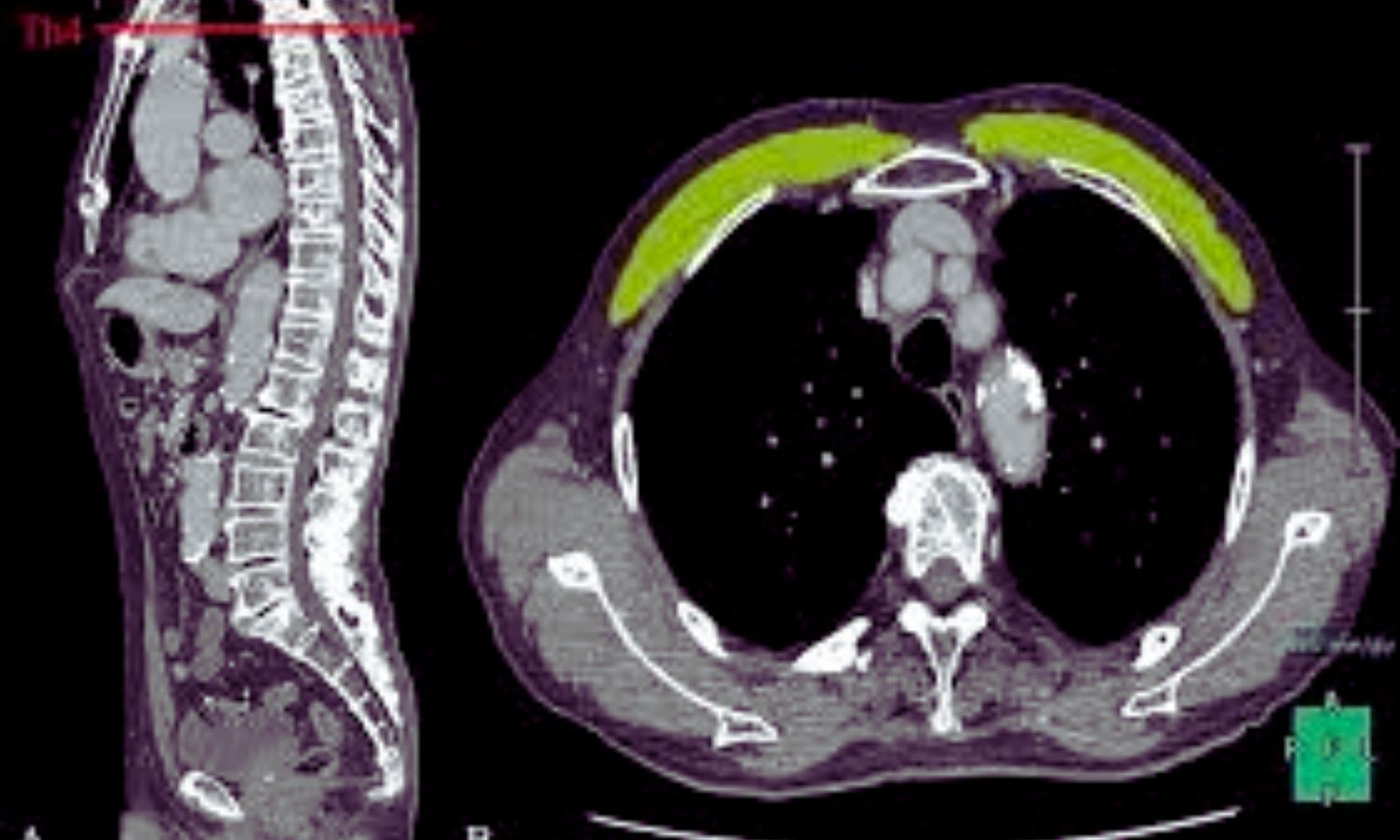 Deep Learning CT Tool Improves Detection of Muscle Loss in COPD ...