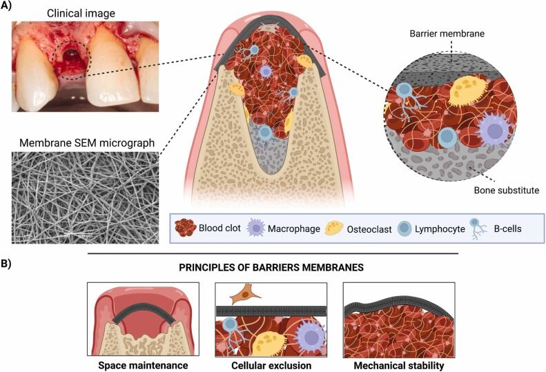 Single dose erythromycin Derived Microparticles Enhance Bone ...