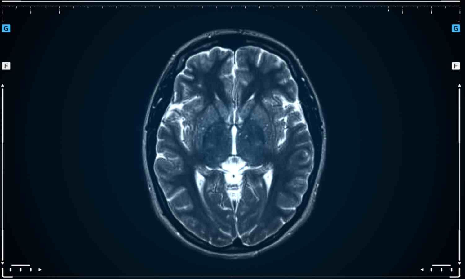 PET suggests potential chronic traumatic encephalopathy biomarker in ...