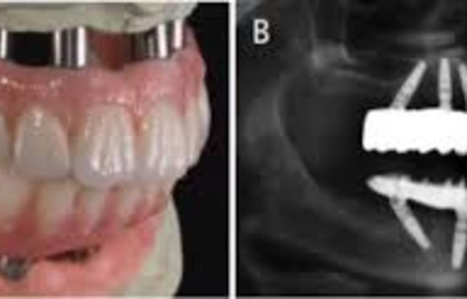 Dual-Hybrid Implant Approach Enhances Tissue Stability and Future ...
