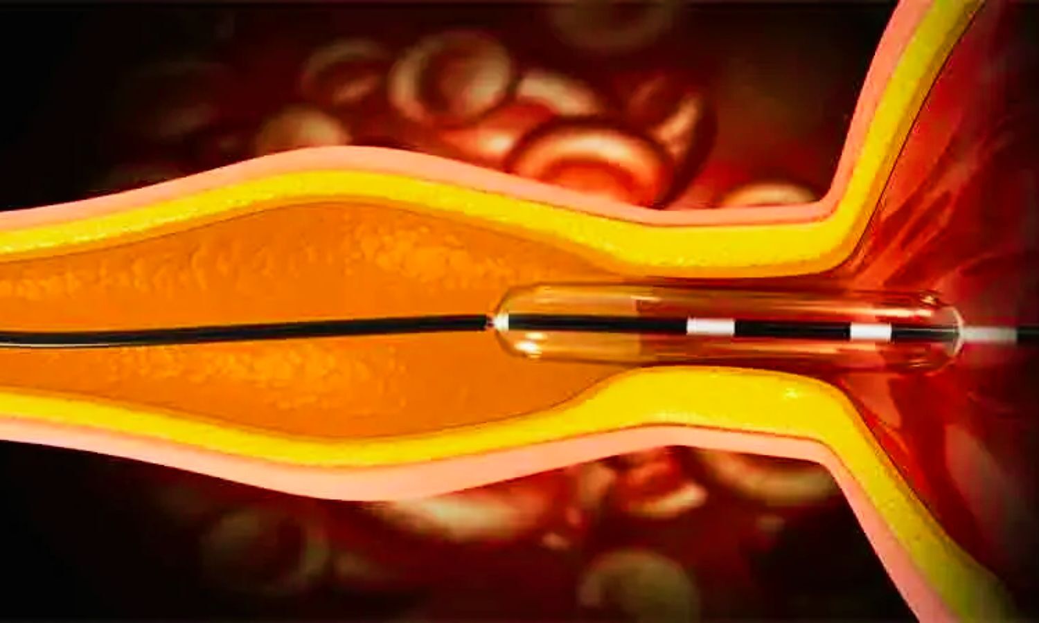 Dual pulmonary Hypertension Therapy Before Balloon Pulmonary ...