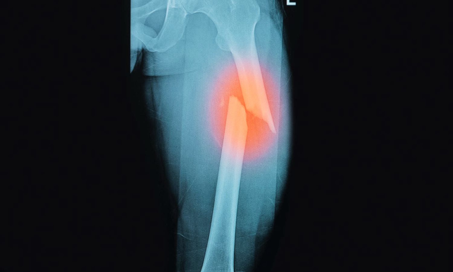 Type 1 Diabetes Linked to Higher Risk of Major Femur and Hip Fractures ...