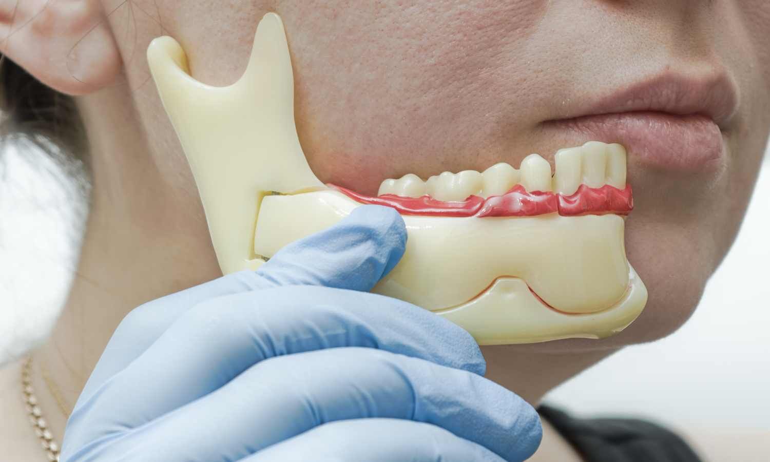 Arthrocentesis may reduce capsular width, Improve Pain and Jaw Function ...