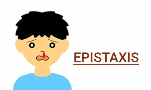 Unusual case of Recurrent Epistaxis due to NASAL Leech Infestation- A ...